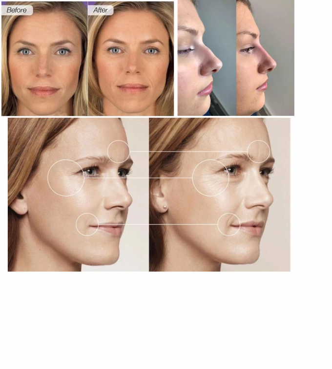 HA Injection Liporase Pcdc Fat Dissolve 24 Mg / Ml การฉีดสลายไขมันในร่างกาย